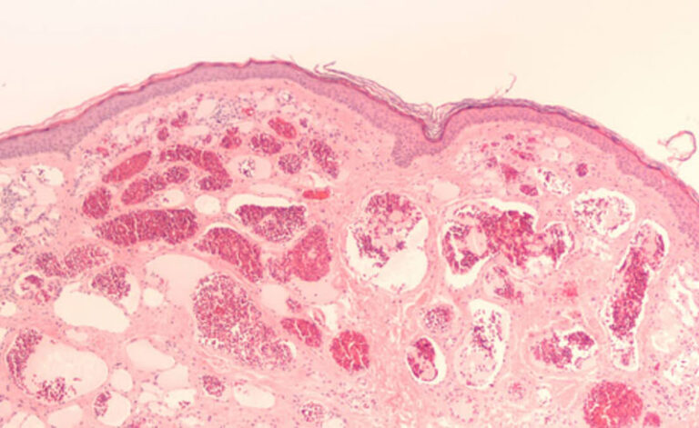 Tratamiento Angiomas en Madrid